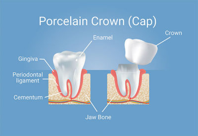 Porcelain Crowns or Caps | San Luis Obispo Dentist Friendly Smiles