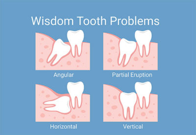 Wisdom Teeth Extractions | San Luis Obispo Dentist Friendly Smiles